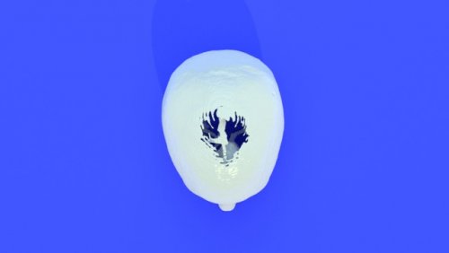 Brain Tumor - stl file processed - democratiz3D® Processing - embodi3D.com