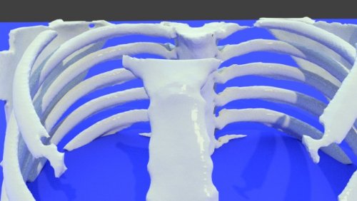 multifile1 - stl file processed - Thorax and Ribs - embodi3D.com