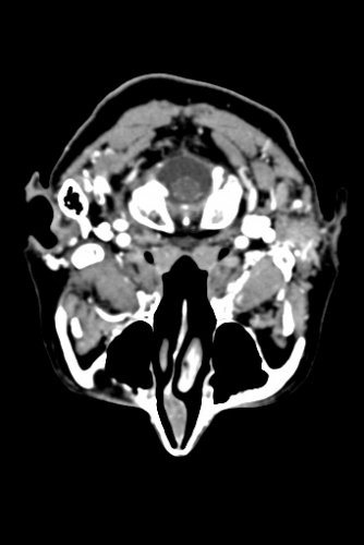 CTA head for video tutorial - Skull, Head, and Neck CTs - embodi3D.com