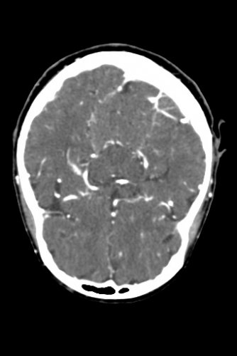 CTA head for video tutorial - Skull, Head, and Neck CTs - embodi3D.com