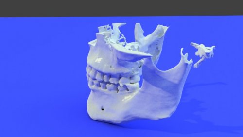 Dentistry - stl file processed - Dental, Orthodontic, Maxillofacial ...