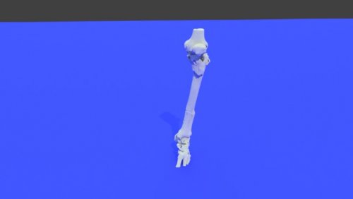 MALUNION OF DISTAL TIBIA - stl file processed - Extremity, Lower (Leg ...