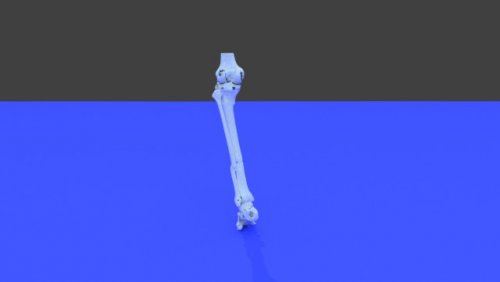 MALUNION OF DISTAL TIBIA - stl file processed - Extremity, Lower (Leg ...