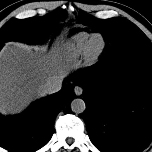 Heart_CTA_1 - Thorax CTs - embodi3D.com