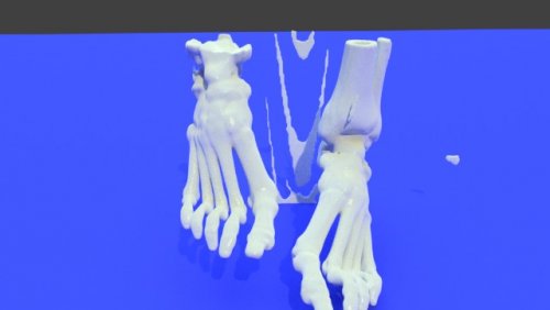 leg - stl file processed - Extremity, Lower (Leg) - embodi3D.com