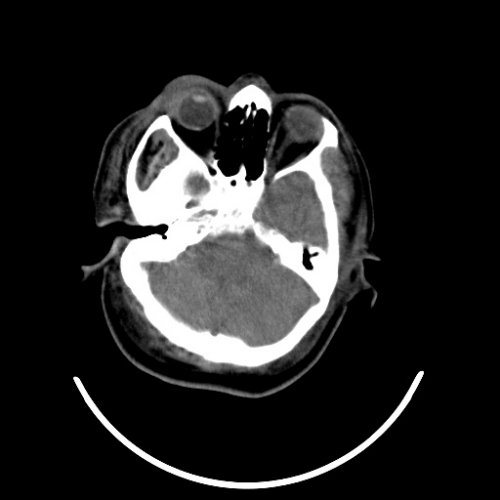 CTA for Head - Skull, Head, and Neck CTs - embodi3D.com