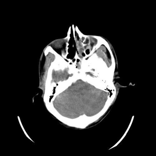 CTA for Head 9 - Skull, Head, and Neck CTs - embodi3D.com