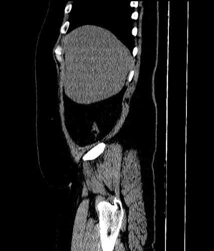 Abdominal CT Scan - Abdomen and Pelvis CTs - embodi3D.com