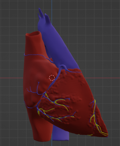 3d model of heart with transposition of the great arteries, long axis ...