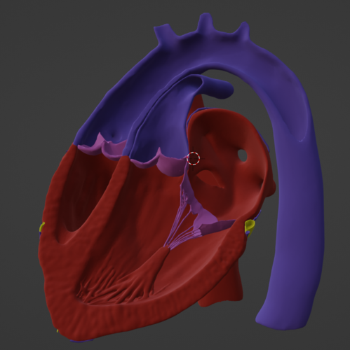 3d model of heart with transposition of the great arteries, long axis ...