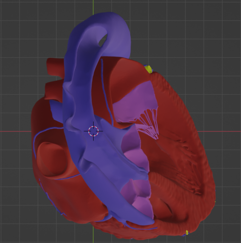 3d model of heart with transposition of the great arteries, long axis ...