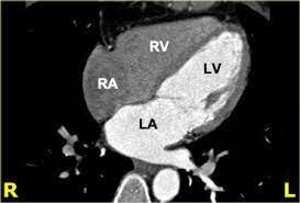 Heart CT scan - democratiz3D® Processing - embodi3D.com