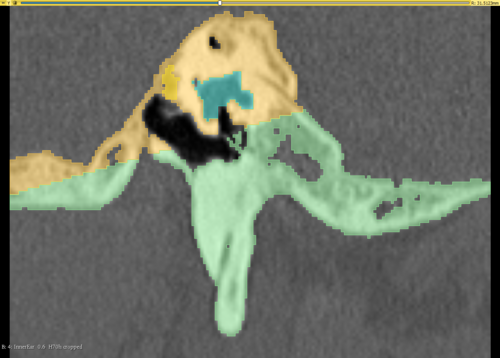 Temporal bone with all inner ear structures reconstructed from CT scan ...
