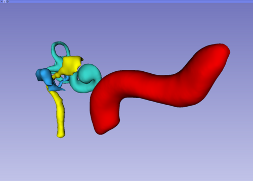 Temporal bone with all inner ear structures reconstructed from CT scan ...