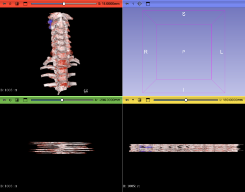 CT Spine with Hardware - democratiz3D® Processing - embodi3D.com