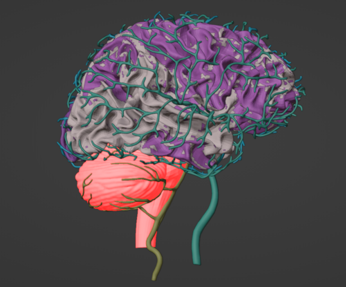 3D Model of Brain and Aneurysm - Brain - embodi3D.com