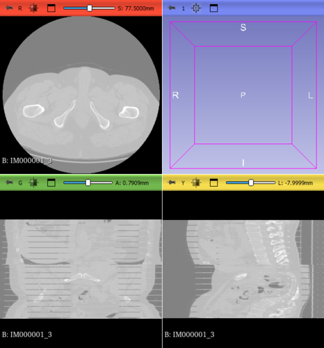 Lumbar One - democratiz3D® Processing - embodi3D.com