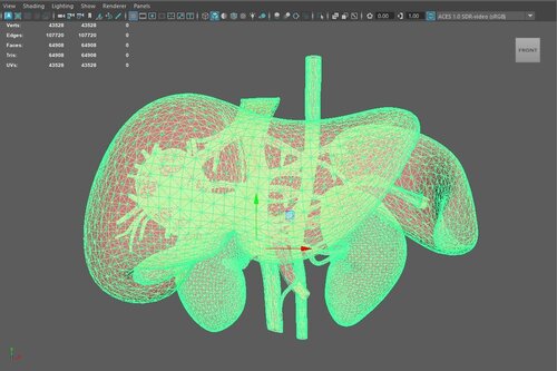 3D Model of Pre- and Post- Operative Liver - Liver - embodi3D.com