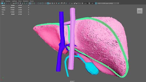 3D Model of Liver with Non-alchocolic steatohepatitis (NASH) - Liver ...