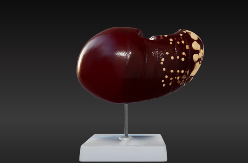 3D Model of Human Liver with the Progression of Liver Disease - Other ...