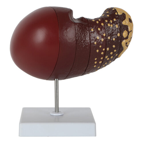 3D Model of Human Liver with the Progression of Liver Disease - Other ...