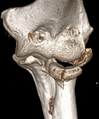 Radius head - democratiz3D® Processing - embodi3D.com