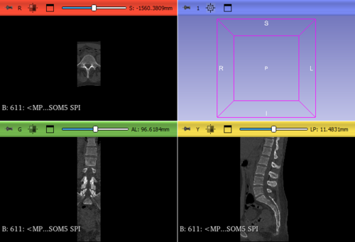 lumbar - democratiz3D® Processing - embodi3D.com